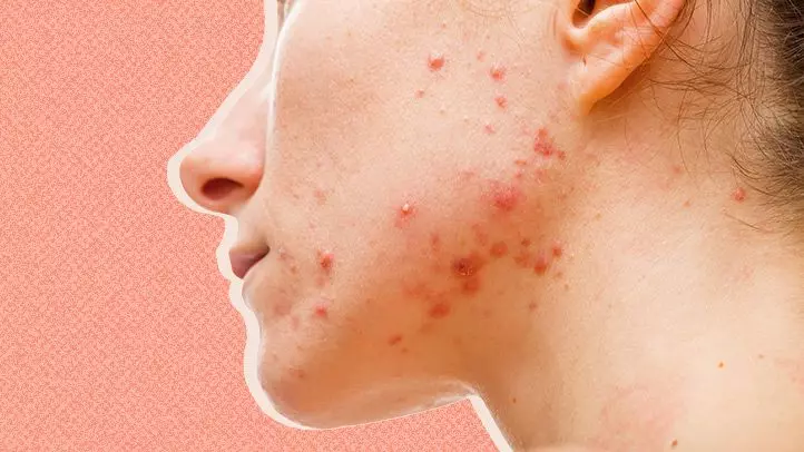 donna con acne lungo la linea della mascella