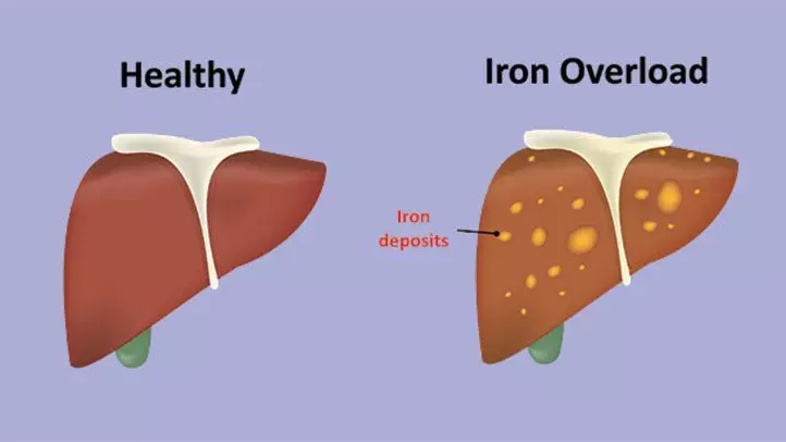 ¿Qué es la hemocromatosis? Causas, síntomas y tratamiento