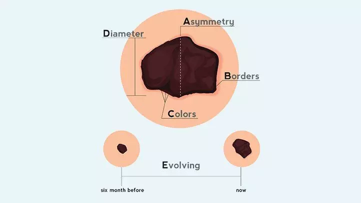 Dermatologen gebruiken het ABCDE-systeem om verdachte moedervlekken te onderzoeken.