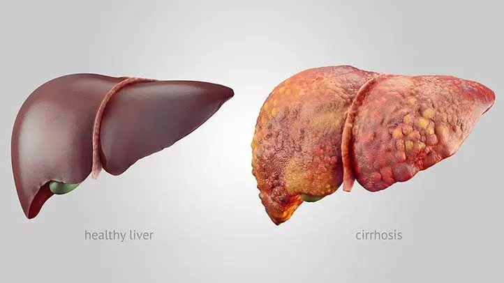 Was ist Zirrhose? Symptome, Ursachen, Diagnose, Behandlung und Vorbeugung