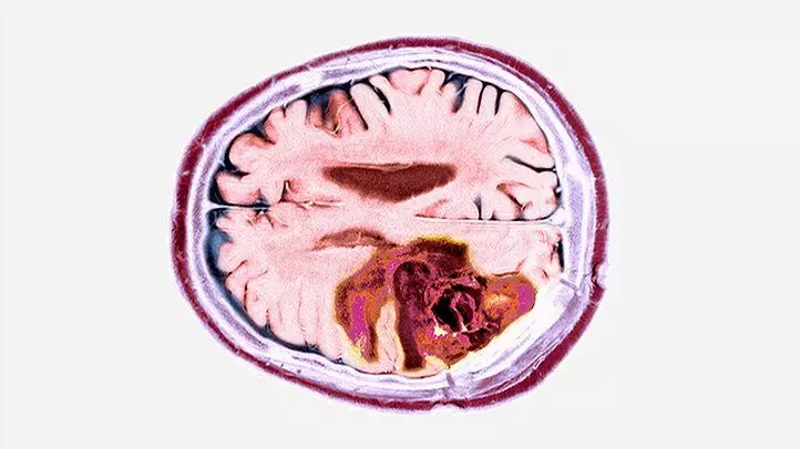 MRI yn dangos glioma yn llabed parietal claf benywaidd 68 oed.