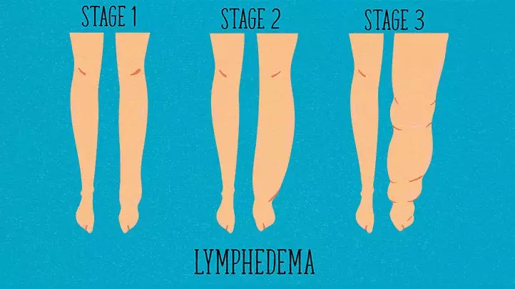 Sıvı birikmesi, lenf düğümleri hasar gördüğünde veya çıkarıldığında kollarda veya bacaklarda şişmeye neden olur.