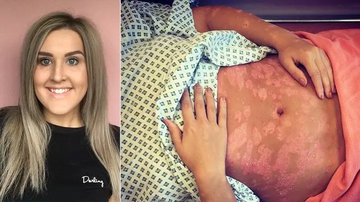 Bryony Bateman، ۽ psoriasis پيچ سان سندس پيٽ جي تصوير