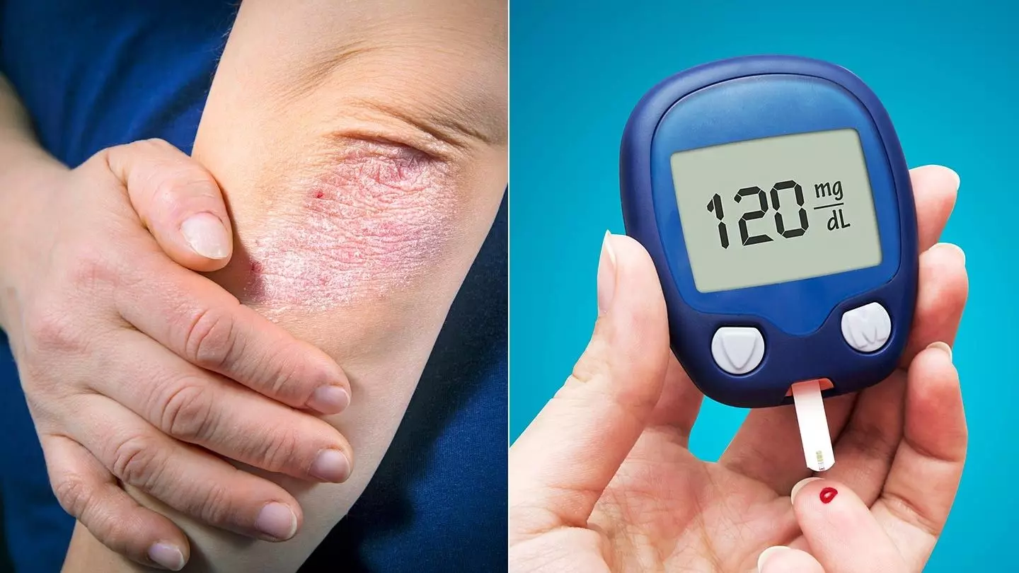 Isang taong may psoriasis at diabetes na gumagamit ng blood sugar tester