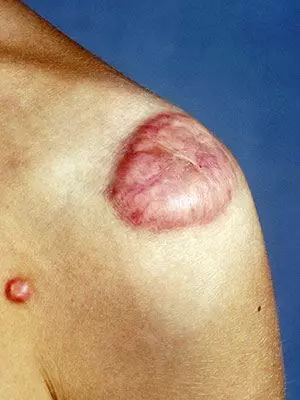 Keloid