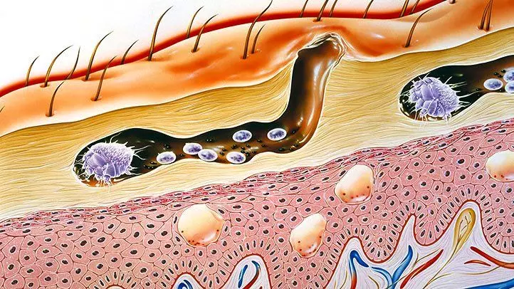 Wat ass Scabies? Symptomer, Ursaachen, Diagnos, Behandlung a Präventioun