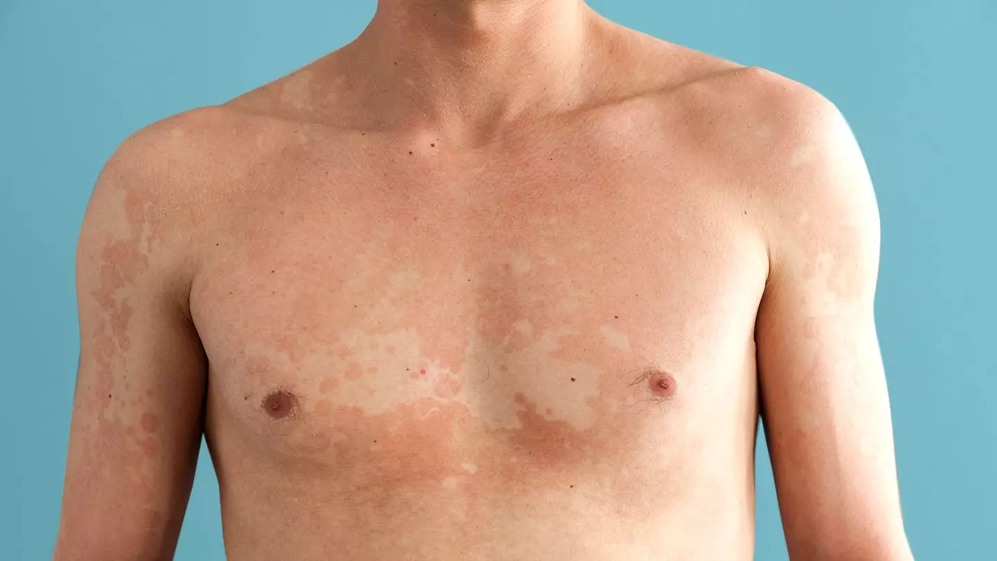 Što je Tinea Versicolor? Simptomi, uzroci, liječenje i prevencija