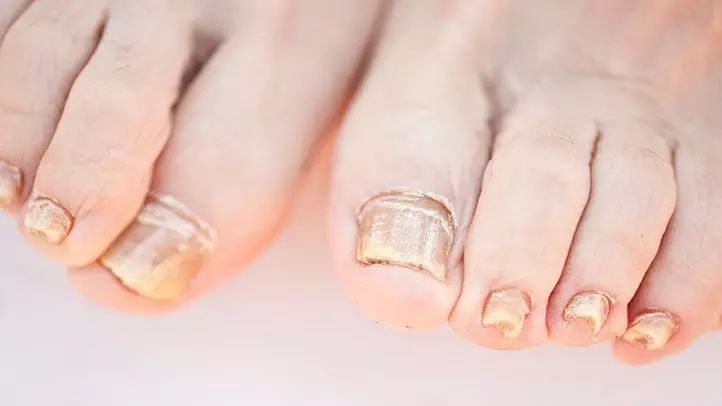 ¿Es un hongo en las uñas de los pies o algo más?