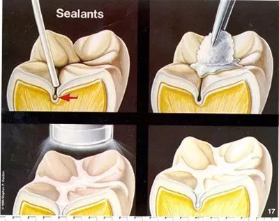 etanșanti dentare pentru carii