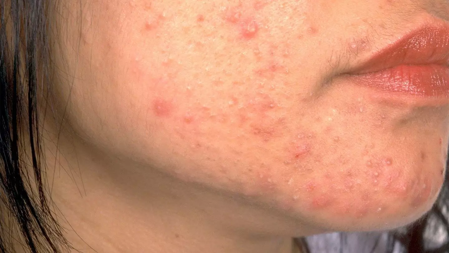 Psoriasis o Acne