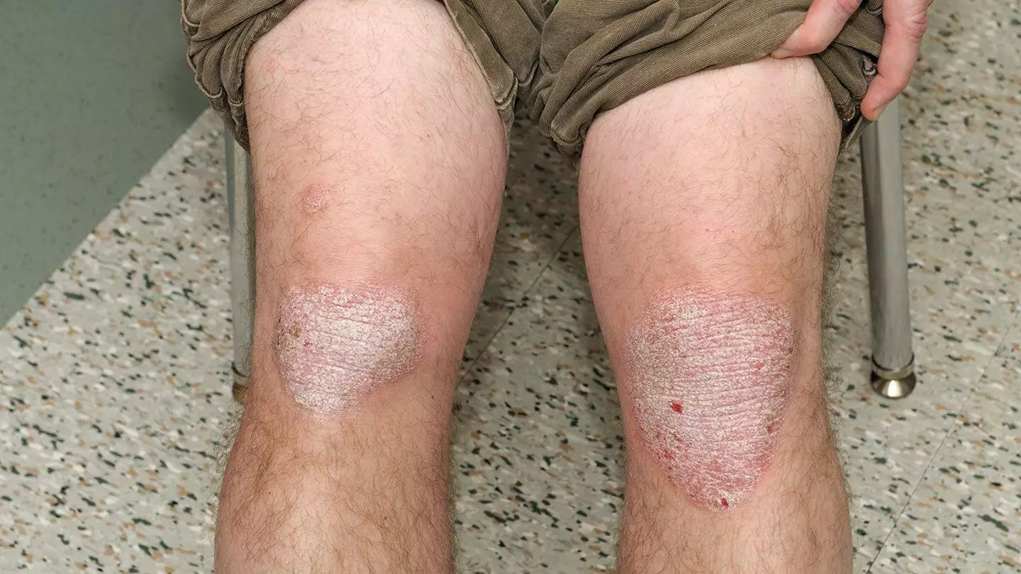 Plaque Psoriasis