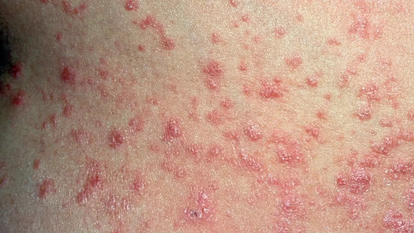 Guttat Psoriasis