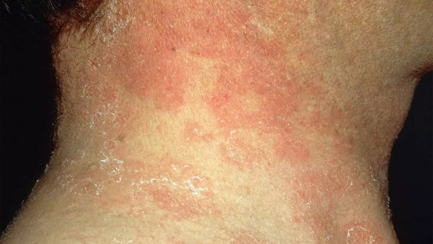 Seborrheic Dermatitis