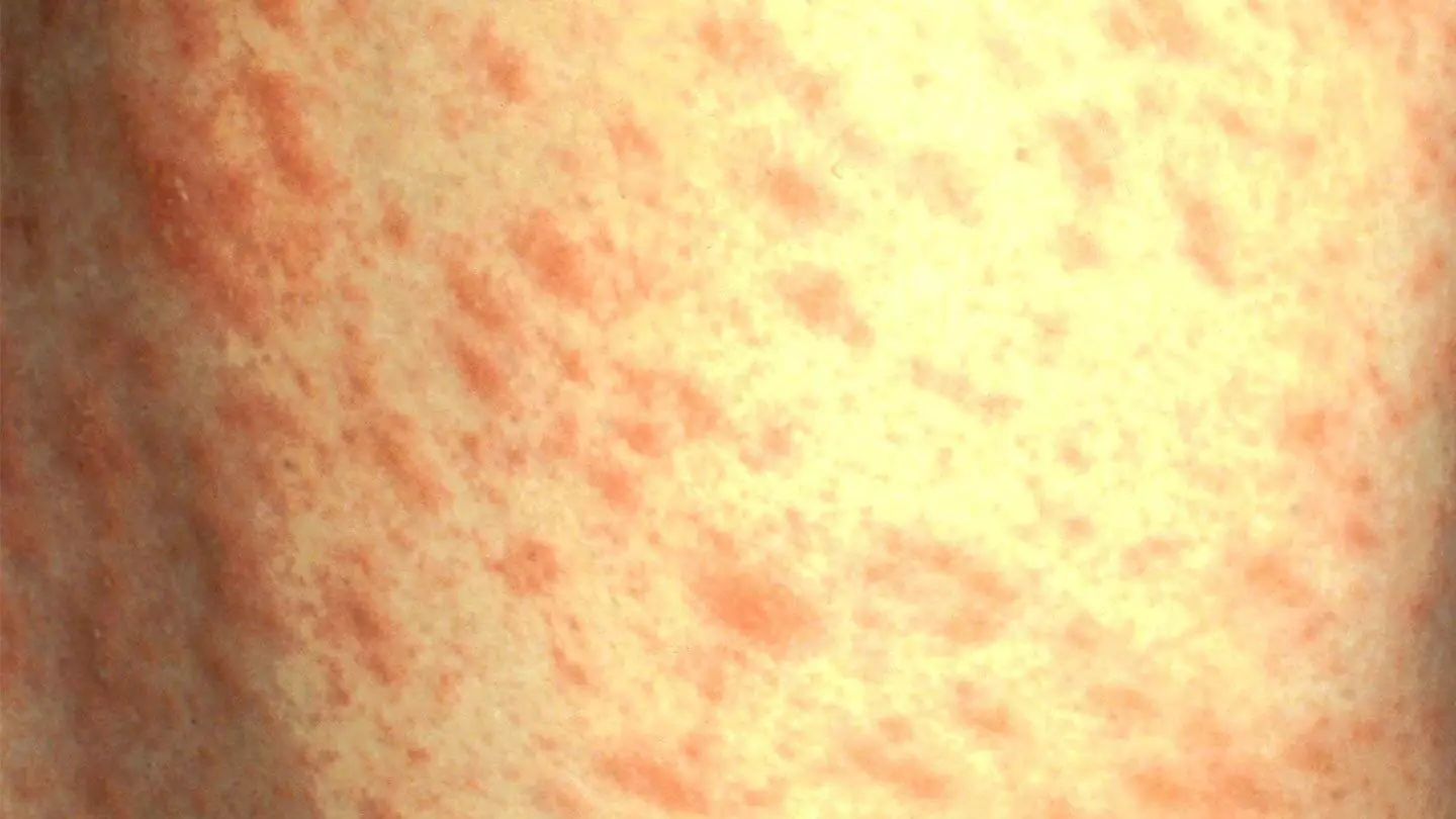 Pityriasis rosea