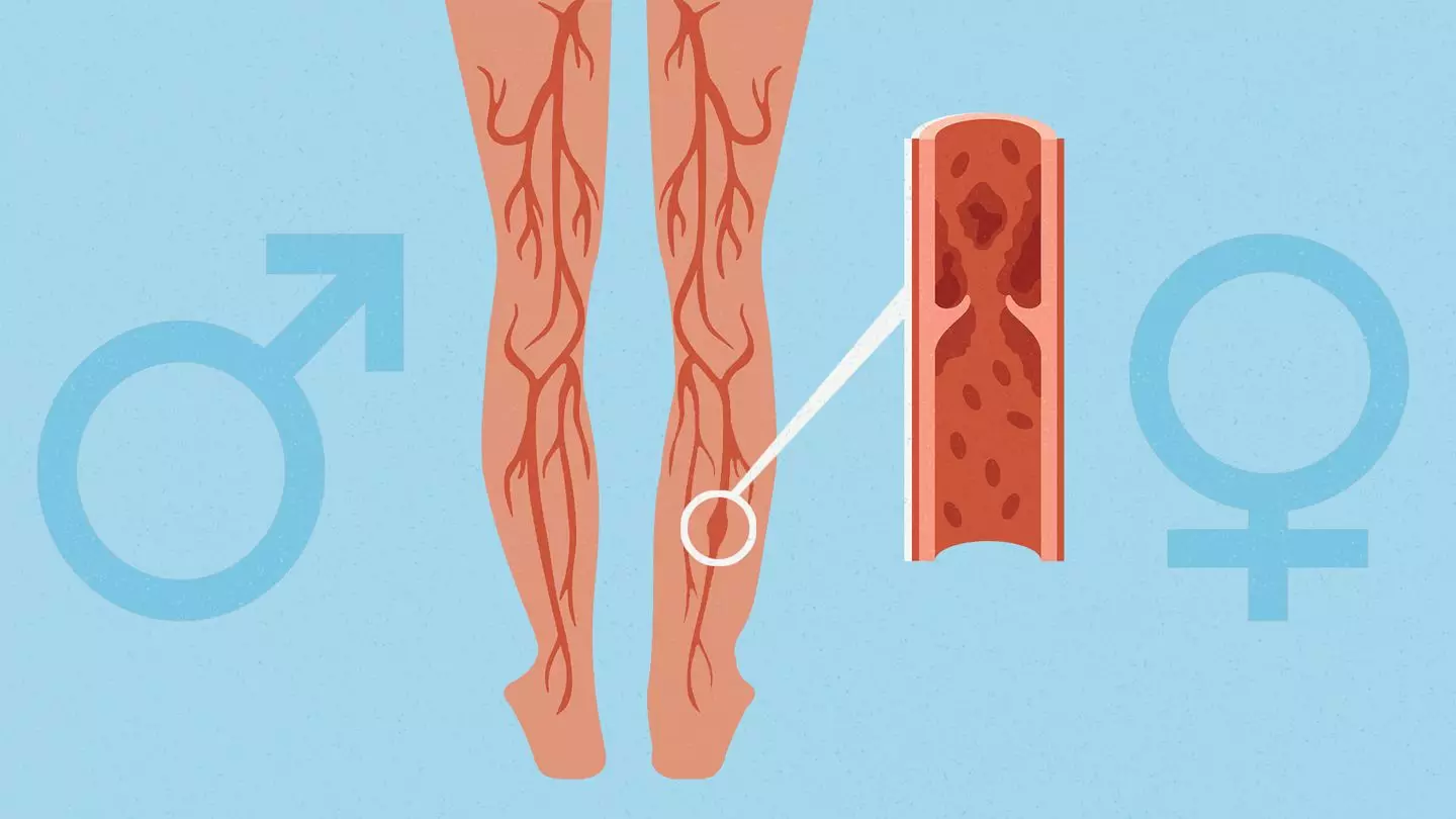 D'Wourecht iwwer Sex Differenzen an Deep Venen Thrombose | Alldag Gesondheet