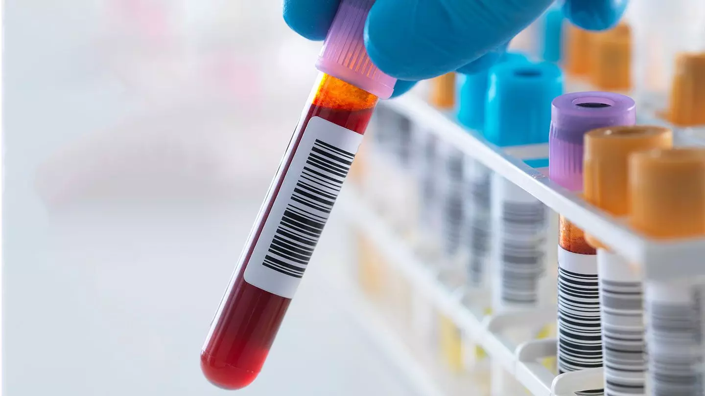 Ukuhlolwa Kwe-Rheumatoid Factor - Ukuxilongwa kwe-RA