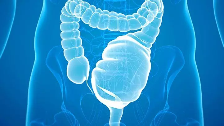 Eitrað Megacolon og sáraristilbólga