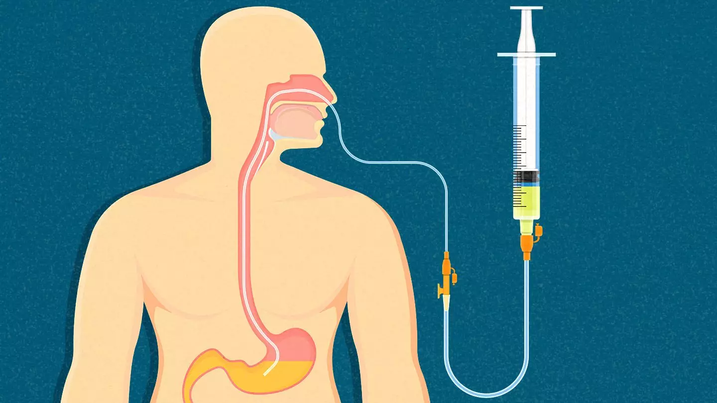 Alimentación enteral por sonda para EPI