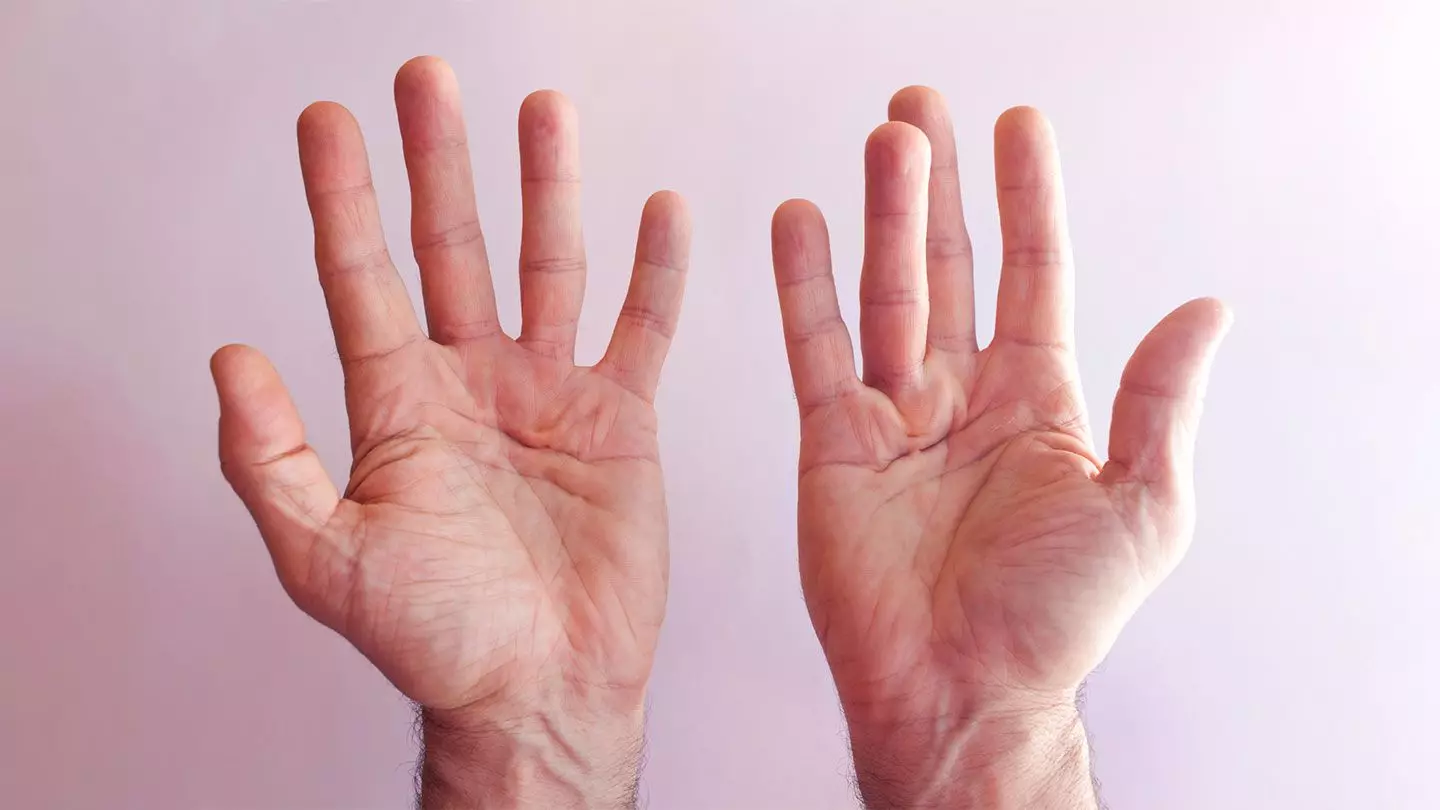 Signes que vous pourriez avoir la contracture de Dupuytren