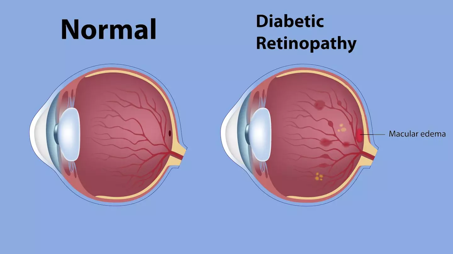 cs-Zomwe-Zimafanana-kukhala-Diabetic-Macular-Edema-1440x810