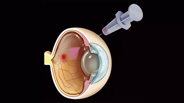 Edema makular diabetikoa tratatzea