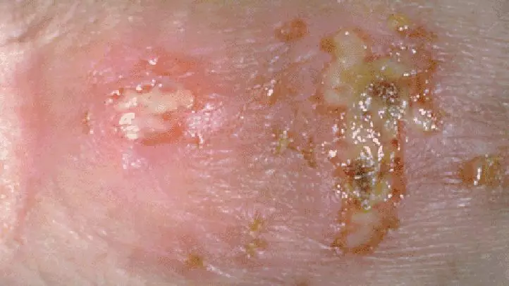 Inona no Endriky ny Herpes Genital Lesion HSV-2