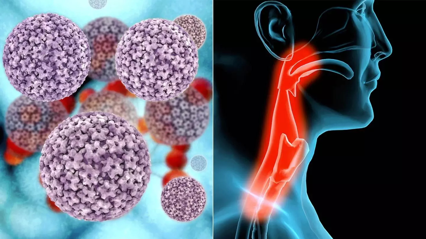 Il cancro alla gola correlato all'HPV è in aumento.