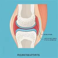 Rheumatoid Arthritis ရောဂါ တိုးတက်မှု- ခြုံငုံသုံးသပ်ချက်