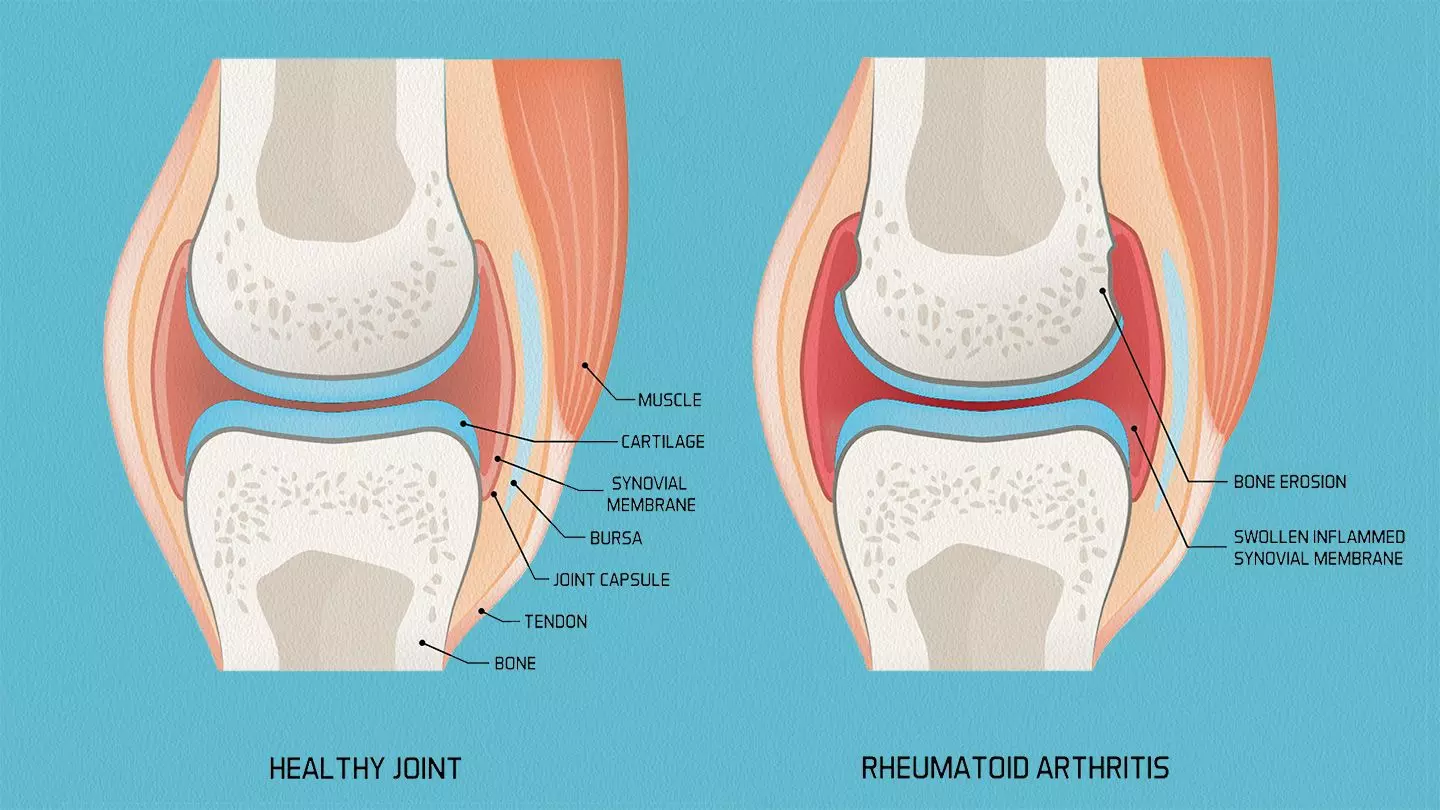 Rheumatoid-Arthritis-njikọ anatomi