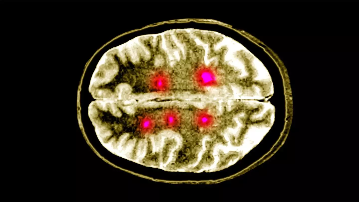 Unha visión do cerebro da EM: o que revelan as novas técnicas de imaxe 2980_1