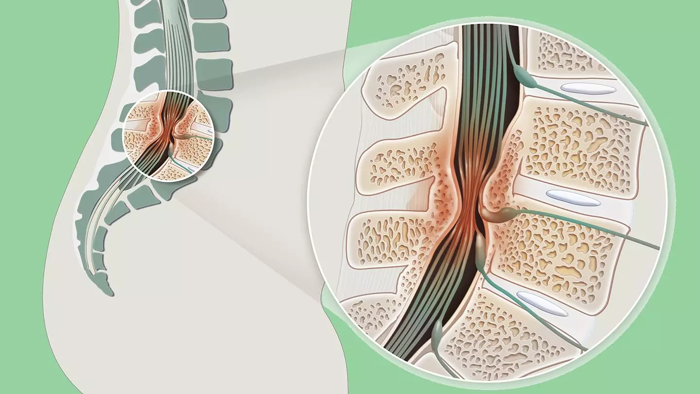 Ang Mabuti at Masamang Balita Tungkol sa Spinal Stenosis