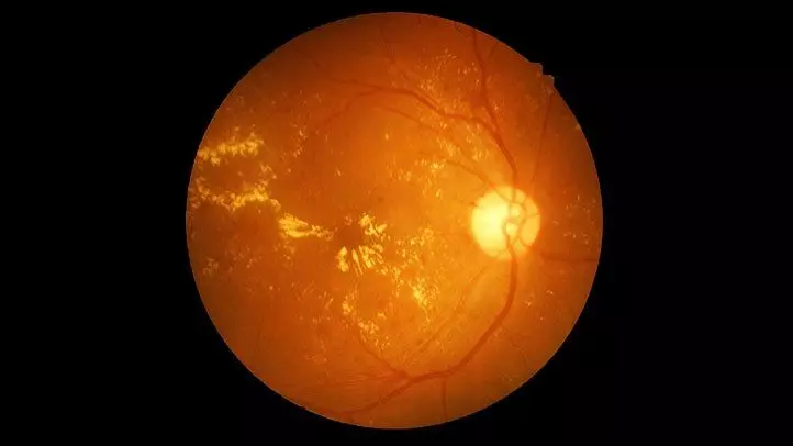 Dry macular degeneration ڇا آهي؟