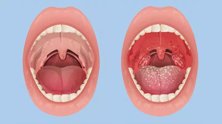 umfanekiso obonisa i-tonsillitis