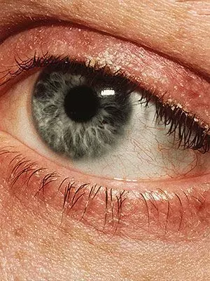 Blepharitis