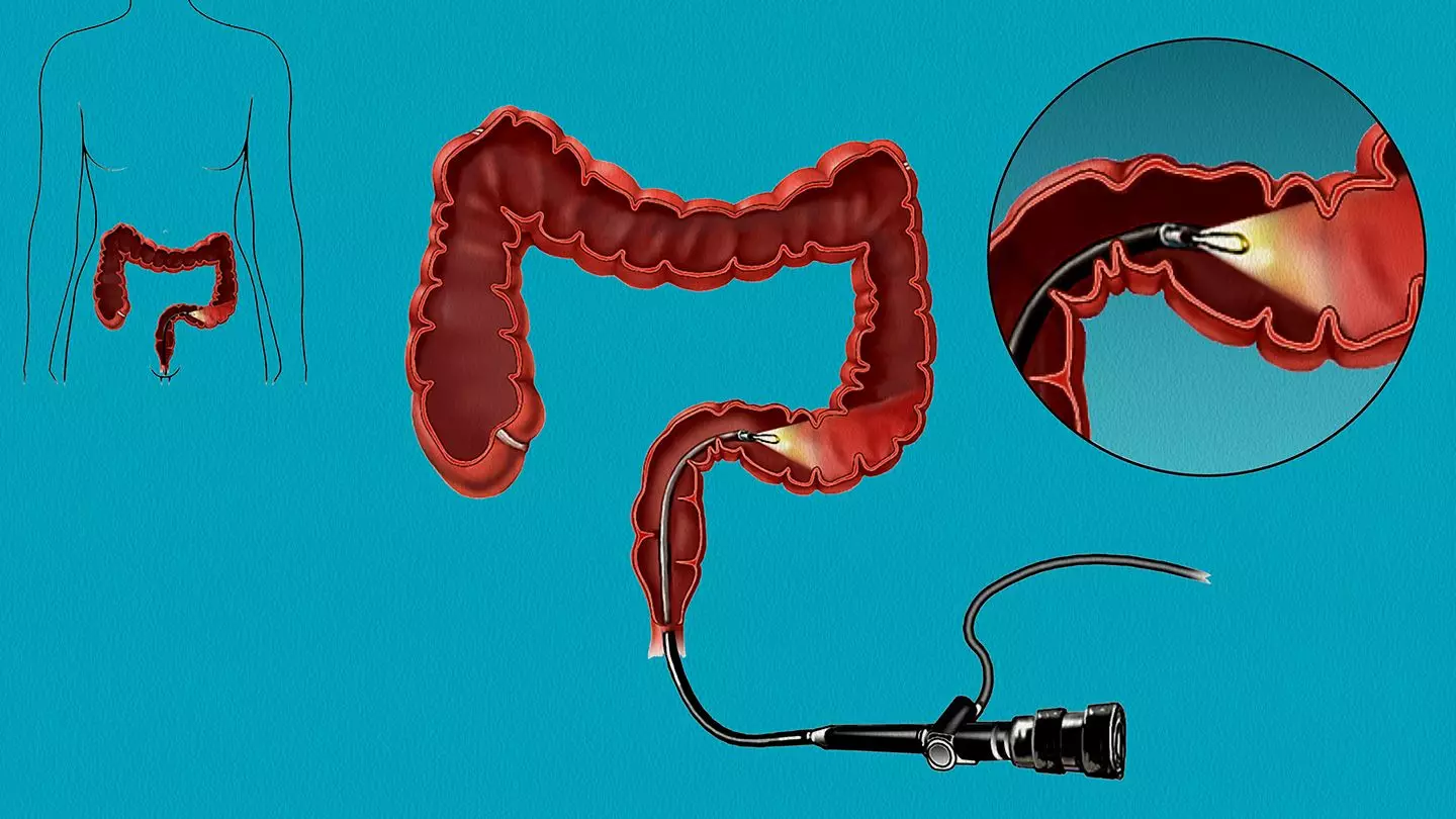 Kas yra sigmoidoskopija? Viskas apie testavimą ir diagnostiką