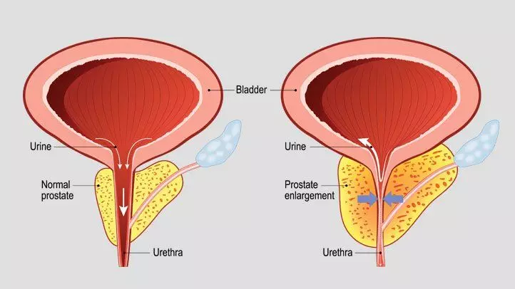 Qanjirka 'prostatic hyperplasia', ama BPH