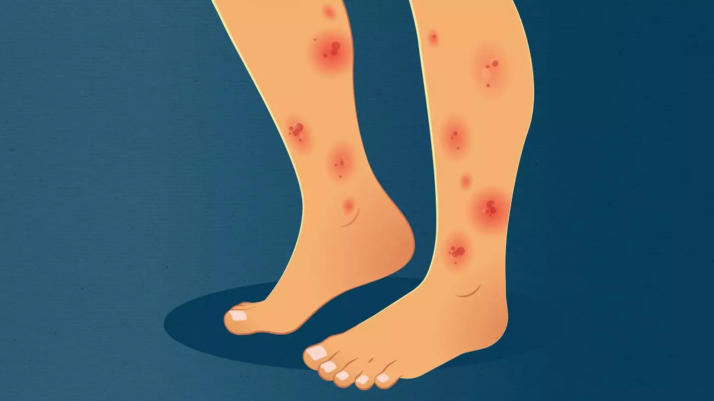 Erythema nodosum