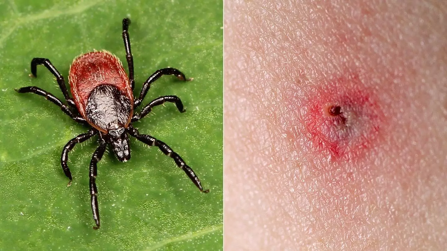 Ang western black legged tick bite makapasa sa Lyme disease.