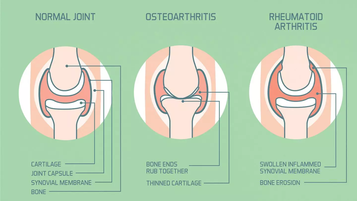 Bolečine v sklepih pri revmatoidnem artritisu proti bolečinam v sklepih pri osteoartritisu