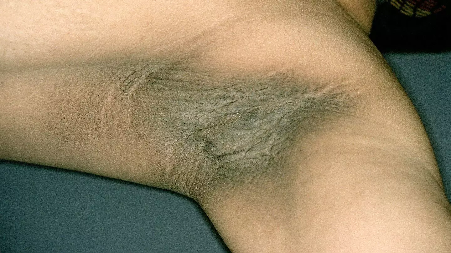 acanthosis nigricans op de arm van een diabetespatiënt