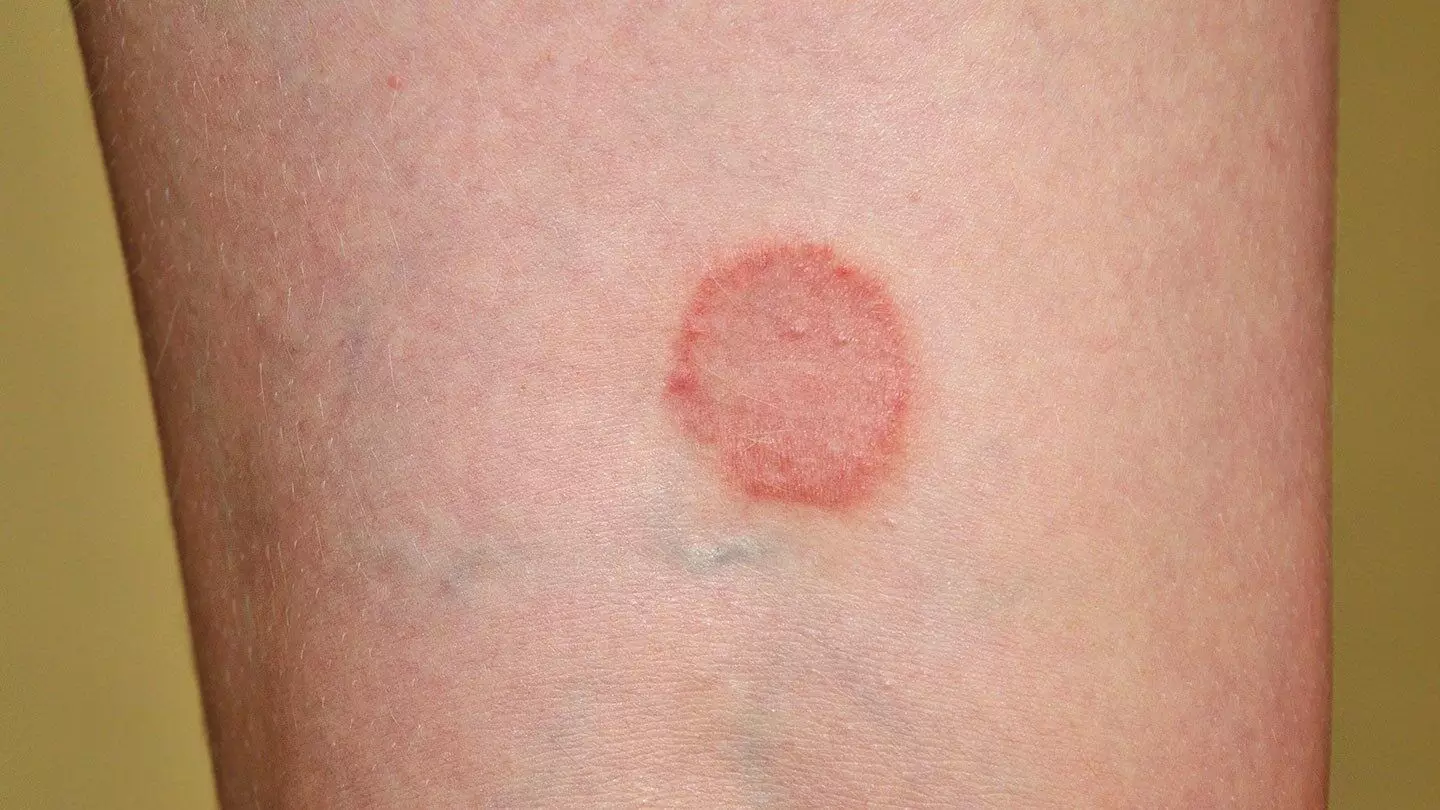 jalma anu diabétes sareng patch ringworm