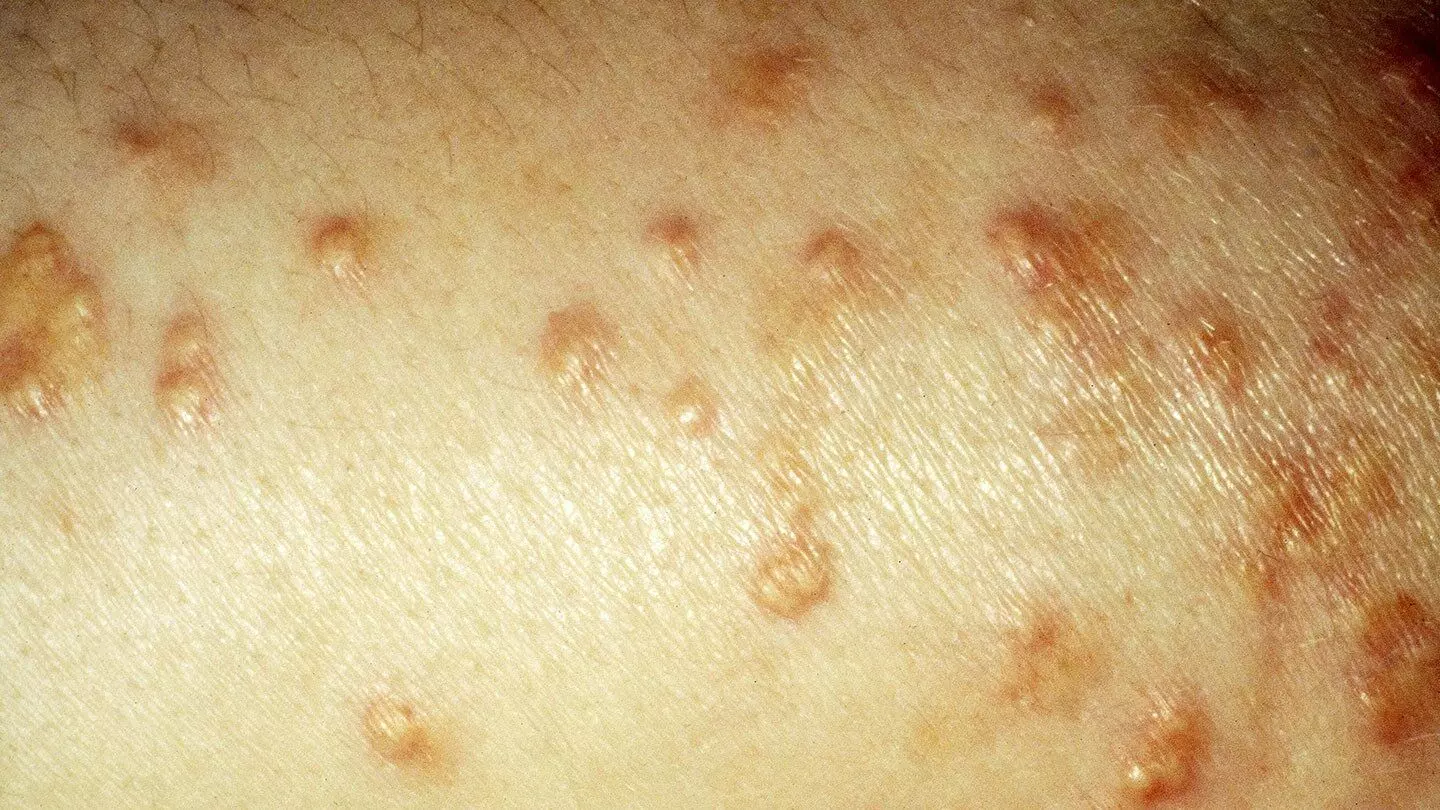 eruptív xanthomatosis cukorbetegek bőrén