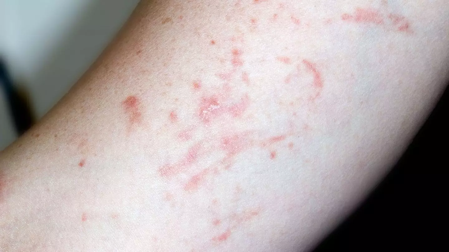 Koebner Fhenomenon and Psoriasis Flares