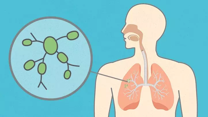 Lymph Nodes များအကြောင်းမေးခွန်းများ