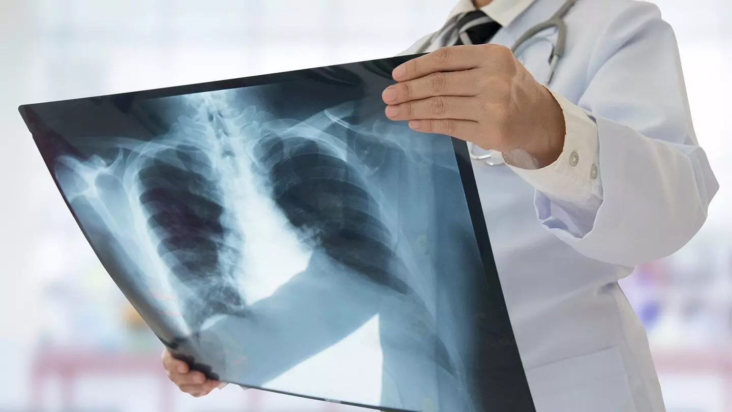 un metge mirant una radiografia per comprovar si hi ha càncer de pulmó