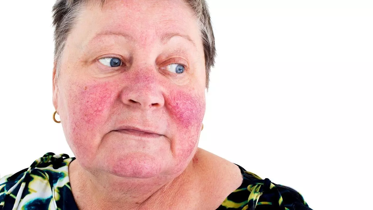 en kvinne med rosacea