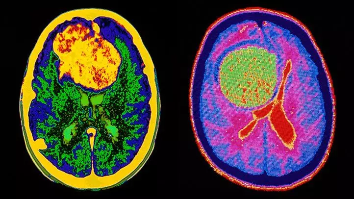 Kev kuaj pom pom meningioma (L), thiab glioma (R), ob qho ntawm feem ntau tshwm sim thawj cov qog hlwb.