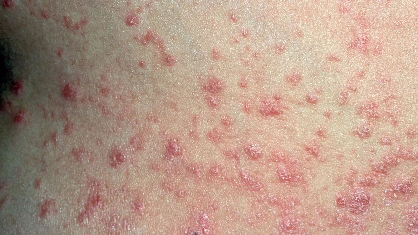 Psoriasis Guttate çi ye? Nîşan û Dermankirin