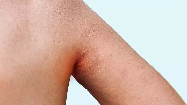 Inverse psoriasis - verborgen maar pijnlijk