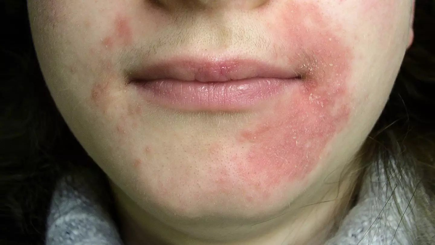 Ano-Ang-Perioral-Dermatitis-1440x810